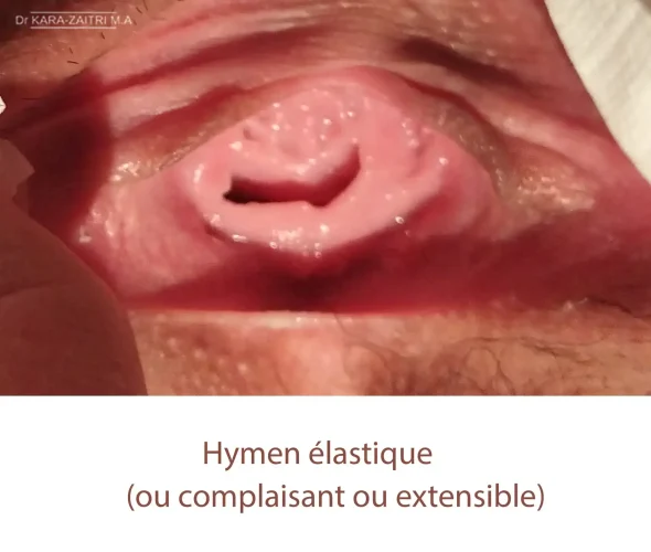 Hymen Dr Kara Zaitri M A Gynécologue Obstétricien